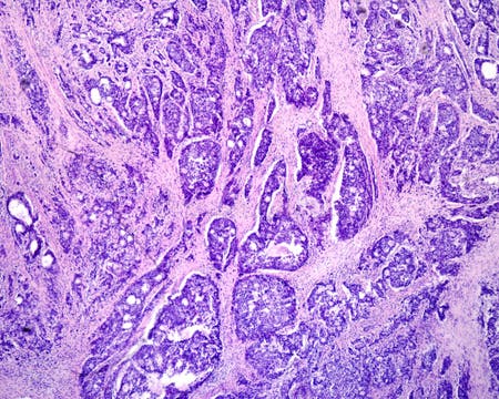 Human Prostate Cancer. Adenocarcinoma Stock Photo - Image of microscopy ...