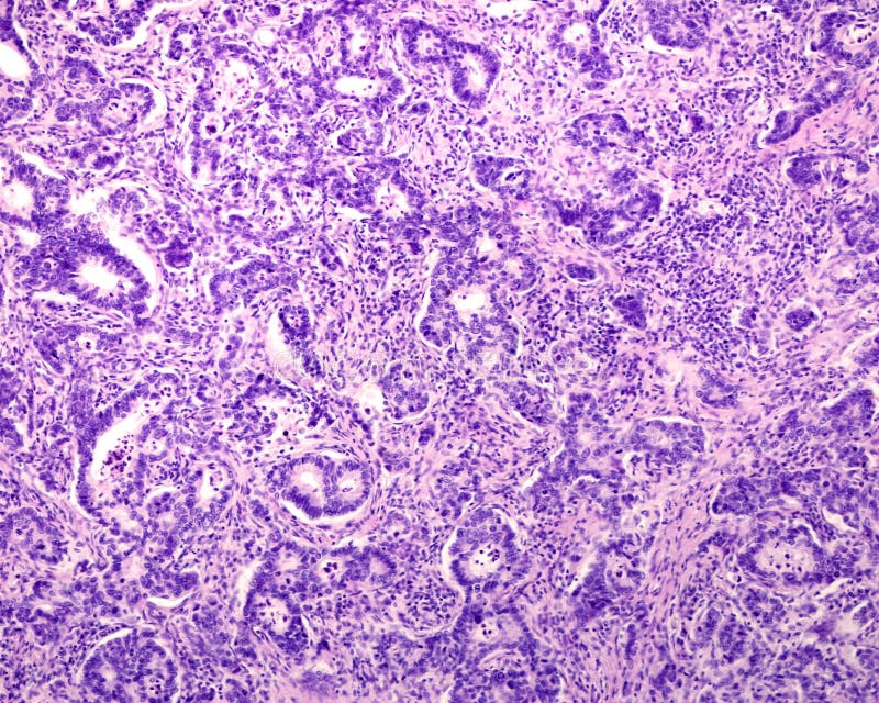 Human Prostate Cancer. Adenocarcinoma Stock Photo - Image of system ...