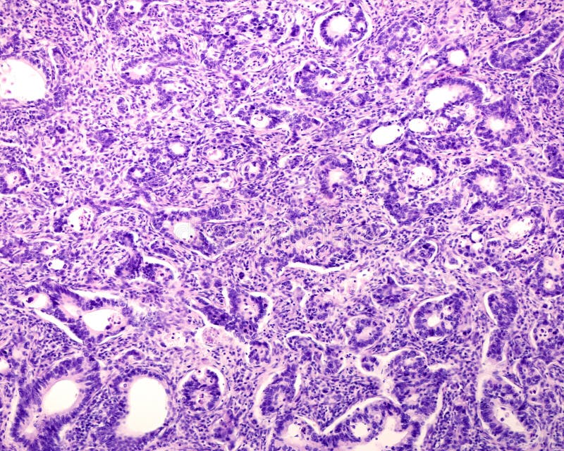 Human Prostate Cancer. Adenocarcinoma Stock Image - Image of cancerous ...