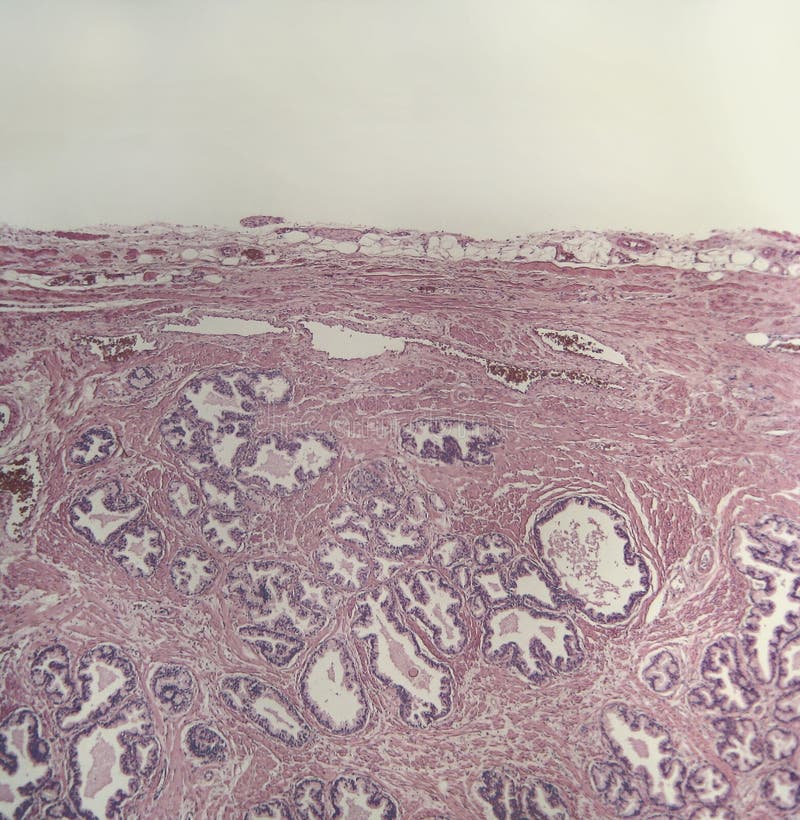 Human Prostate Gland, Microscopic Stock Image - Image of benign, cancer ...