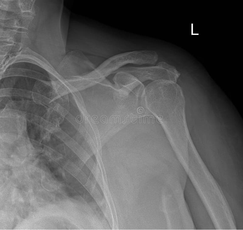 Human Radiograph Showing Shoulder Joint Stock Image - Image of shoulder ...