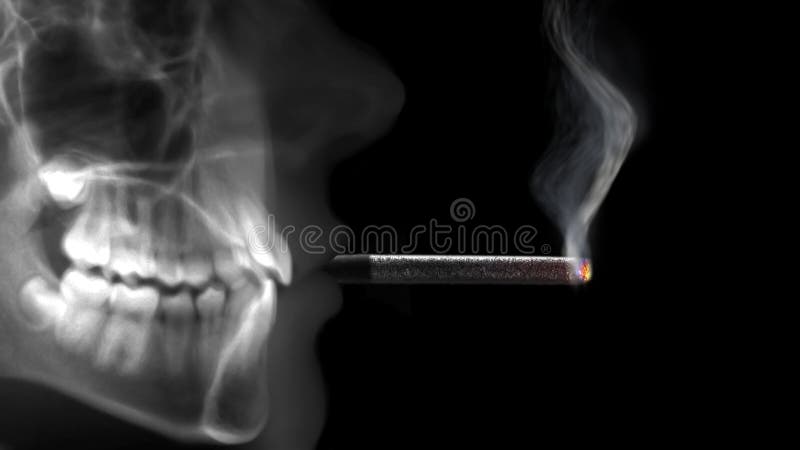 Human X-ray with Cigarette Smoke Stock Photo - Image of smoke ...