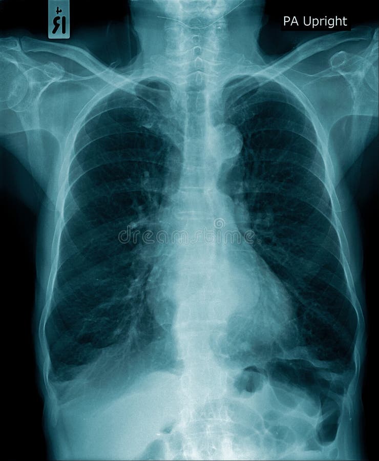 Human X-ray Image, Chest X-ray Stock Image - Image of diagnostic ...