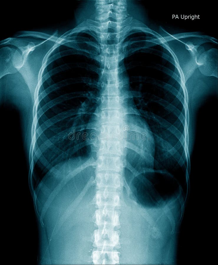 Chest X-ray Show Inside of Lung Stock Image - Image of back, medical ...