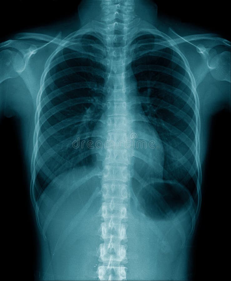 Chest X-ray Show Inside of Lung Stock Photo - Image of checkup, exam ...