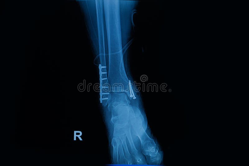 Human X-rays Showing Fracture of Right Leg Stock Image - Image of ...
