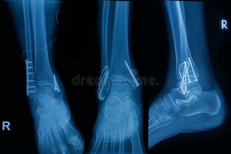 Human X-rays Showing Fracture of Right Leg Stock Photo - Image of crash ...