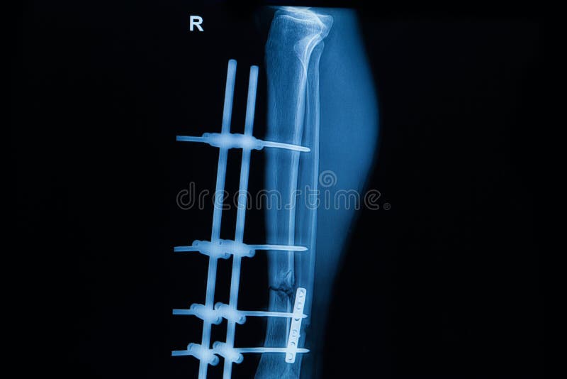 Human X-rays Showing Fracture of Right Leg Stock Image - Image of bone ...