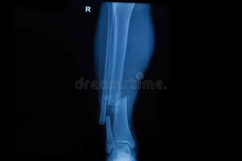 Human X-rays Showing Fracture of Right Leg Stock Photo - Image of ...