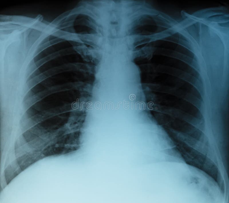 Rib Cage Skeleton Human Bones Stock Photos - Free & Royalty-Free Stock ...