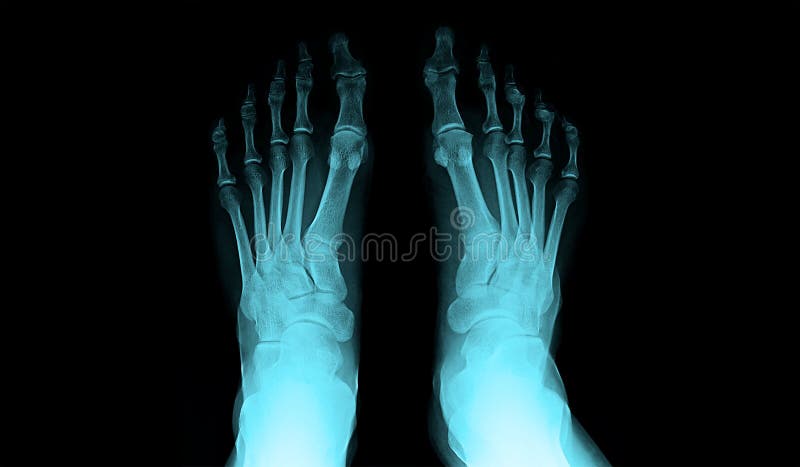 Normal Left Ankle Xray