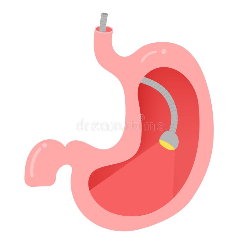 Human S Stomach, Stomach Endoscopy. Stock Vector - Illustration of ...