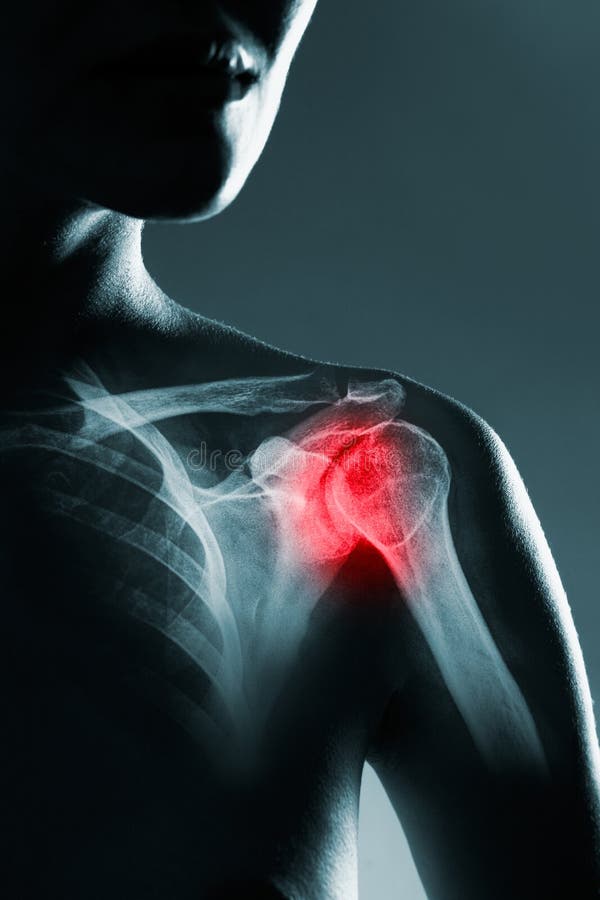 Human Shoulder Joint in X-ray on Blue Background Stock Image - Image of ...