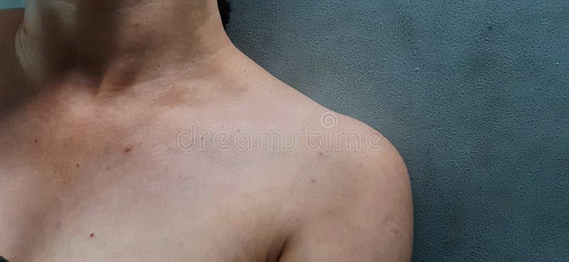 Human Shoulder with Moles Pimples Stretch Marks Pigmentation Stock ...