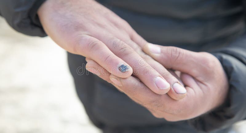 Human Showing Broken Nail in Hand Stock Photo - Image of health, care ...