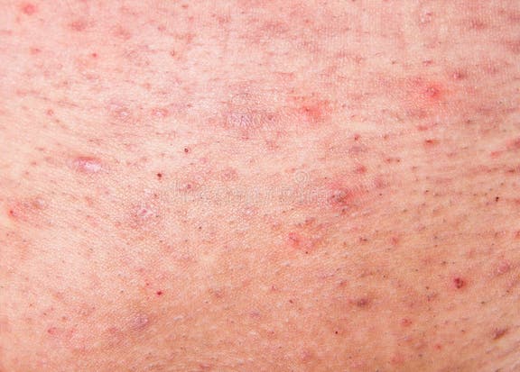 Human skin with acne stock photo. Image of outbreak, macro - 28330198