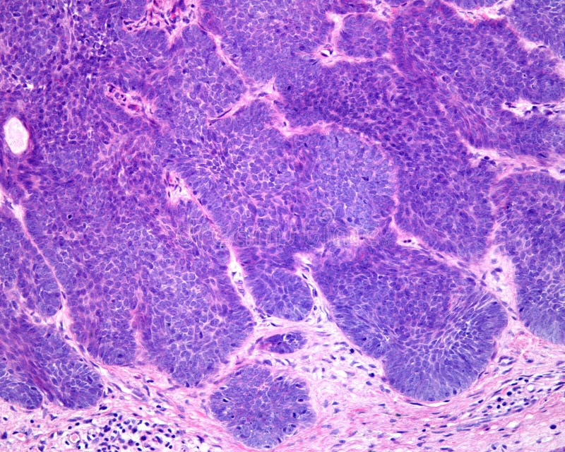 Human Skin Basal Cell Carcinoma Stock Image Image Of Cells