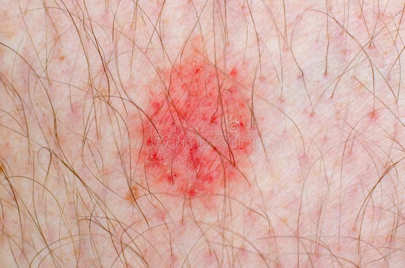 Human skin cancer close up stock photo. Image of dermatological - 356994522