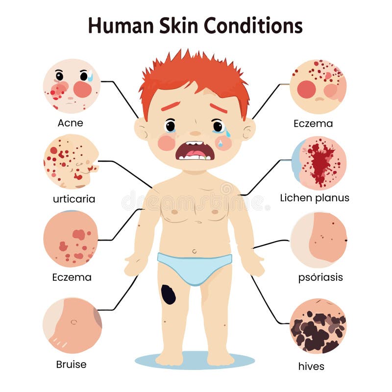 Skin Condition Cartoon Stock Illustrations – 605 Skin Condition Cartoon ...
