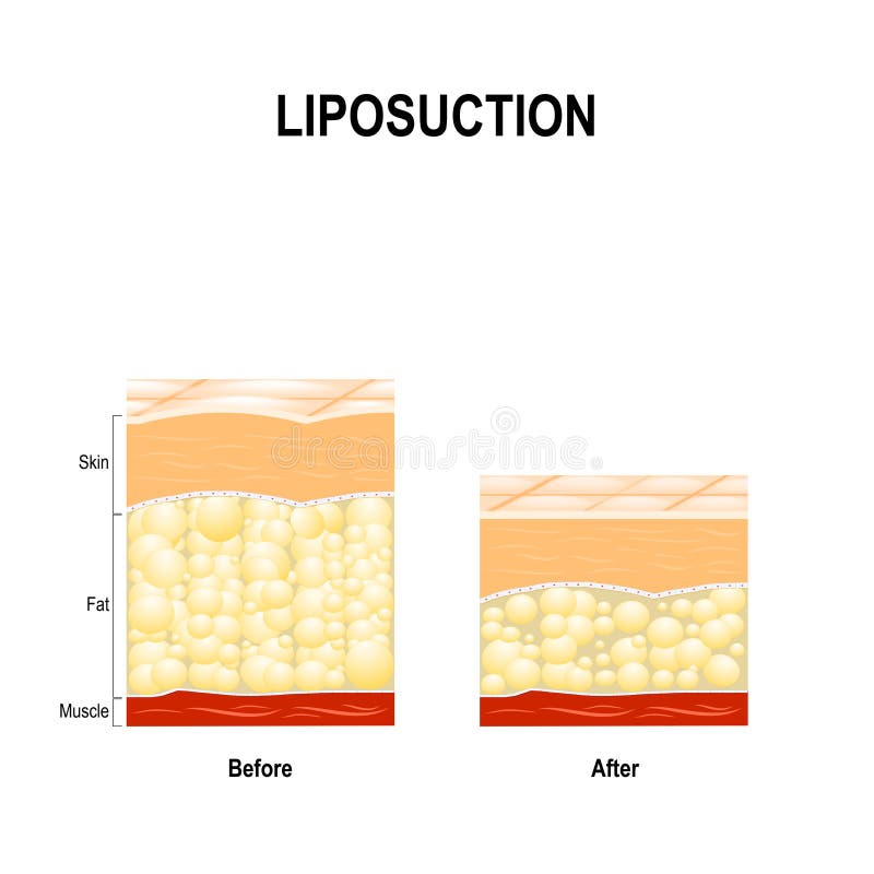 Human Skin Layer Lipo Liposuction Stock Illustrations – 13 Human Skin ...