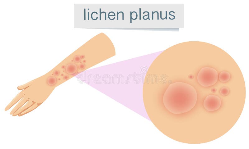 Human Skin With Lichen Planus Stock Vector Illustration Of Immune