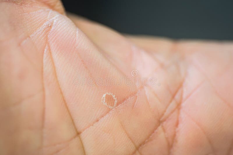 Human Skin Peels Skin on the Palms of the Hands. Stock Image - Image of ...