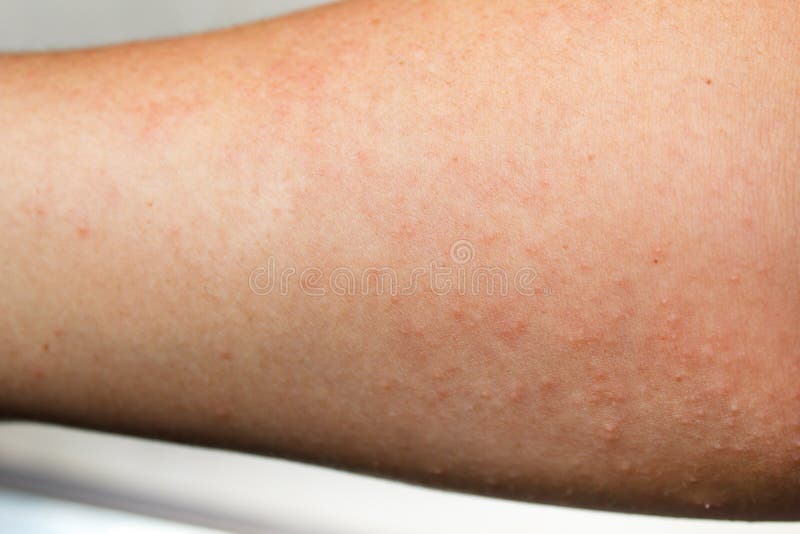Human Skin, Presenting an Allergic Reaction. Stock Photo - Image of ...