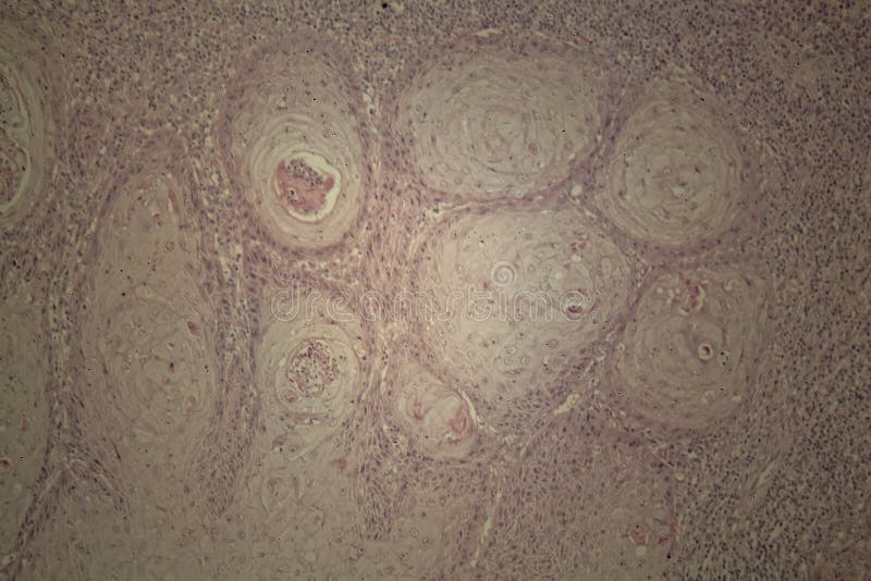 Human Skin with Squamous Cell Carcinoma Stock Photo - Image of biology ...