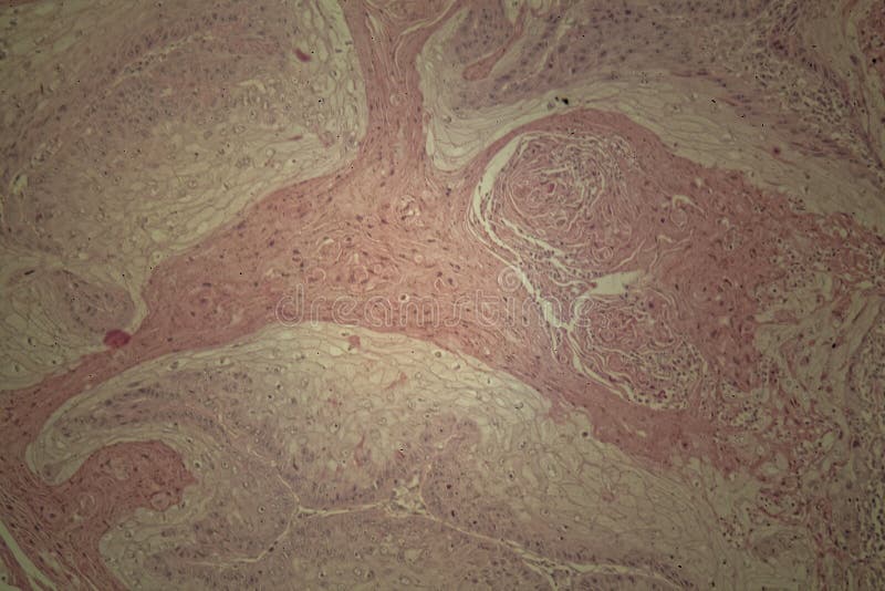 Human Skin with a Scabies Infection, Sarcoptes Scabiei, Under the ...