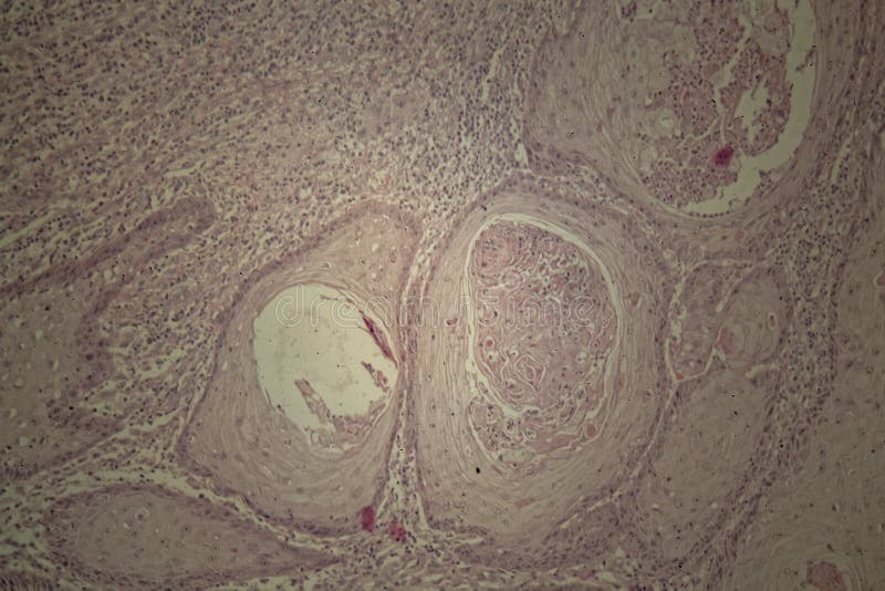 Human Skin with a Scabies Infection, Sarcoptes Scabiei, Under the ...