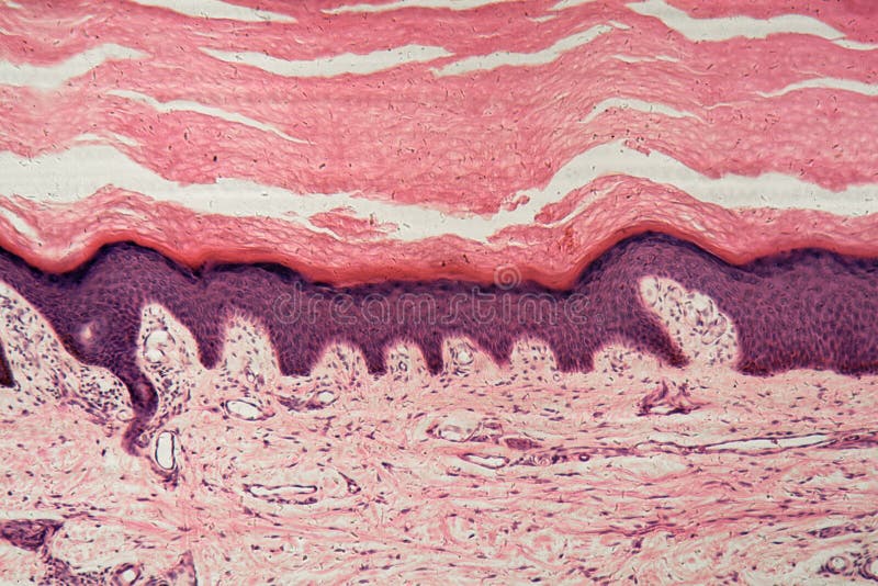 Human Skin with a Scabies Infection, Sarcoptes Scabiei, Under the ...