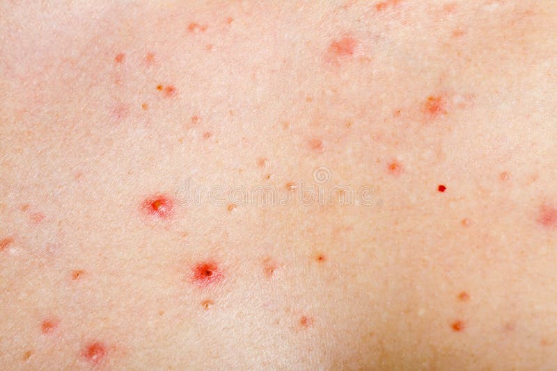 Acne Skin Texture stock photo. Image of complexion, bacillus - 12499106