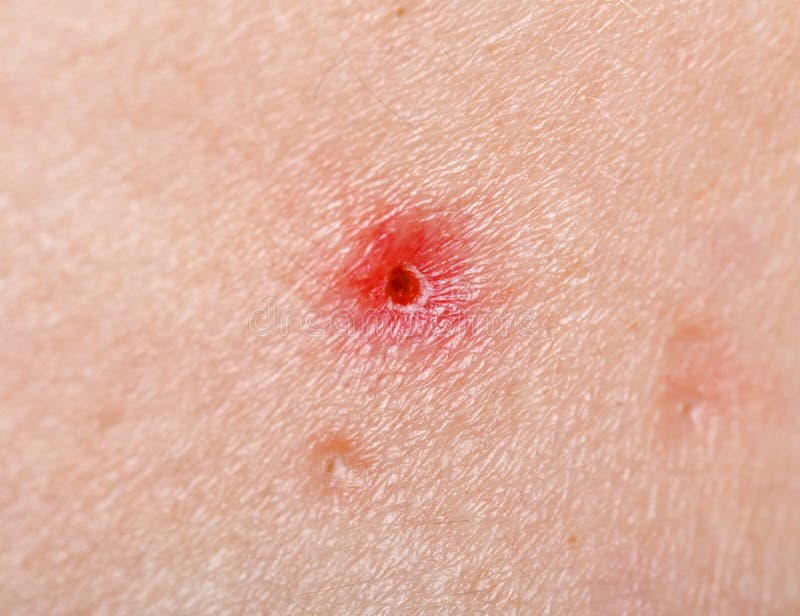 Tick burrowing in skin stock photo. Image of parasite - 21688684