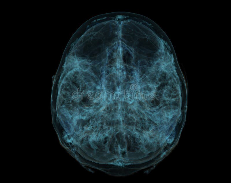 Human Skull, Brain by CT Scan. X-ray Visualization Inside of Skull ...
