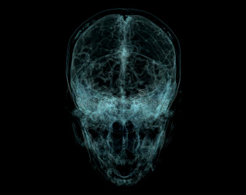 Human Skull, Brain by CT Scan. X-ray Visualization Inside of Skull ... Human Skull, Brain by CT Scan. X-ray Visualization Inside of Skull ...
