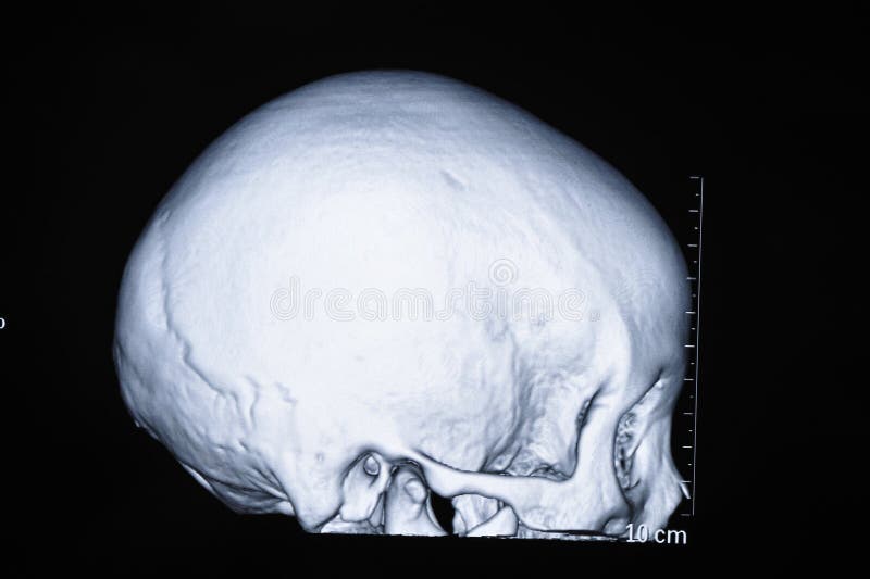 Human skull CT scans stock illustration. Illustration of light - 365253877