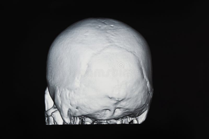 Human skull CT scans stock photo. Image of human, neurosurgery - 373748066