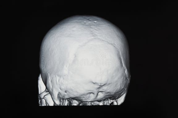 Human skull CT scans stock photo. Image of human, neurosurgery - 373748066