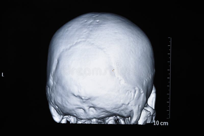Human skull CT scans stock image. Image of light, head - 353892039
