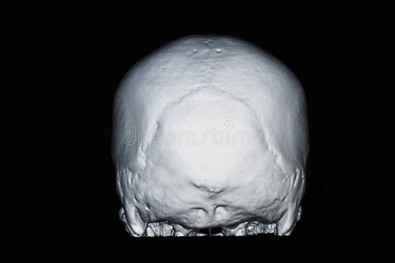 Human skull CT scans stock photo. Image of neurology - 373748054