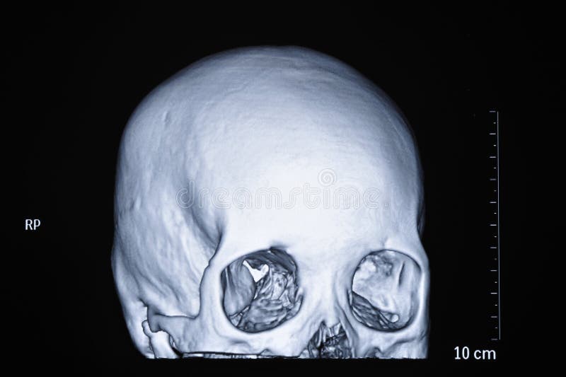Human skull CT scans stock image. Image of plastic, scanning - 309580099