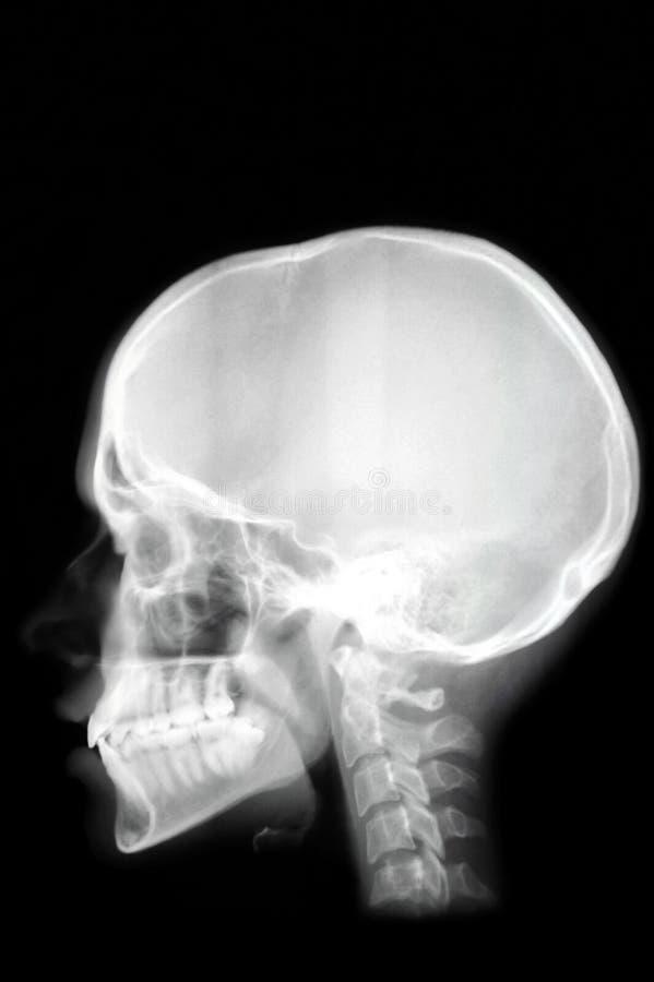 Human skull X Ray stock photo. Image of health, patient - 45843482