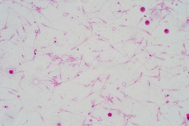 Human Sperm Morphology Under Microscope. Stock Photo - Image of icons ...