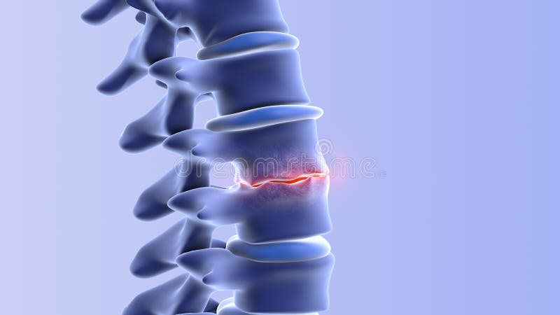 Spine Formation Stock Illustrations – 40 Spine Formation Stock ...