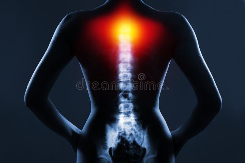 Human Spine in X-ray on Blue Background. the Neck Spine is Highlighted ...