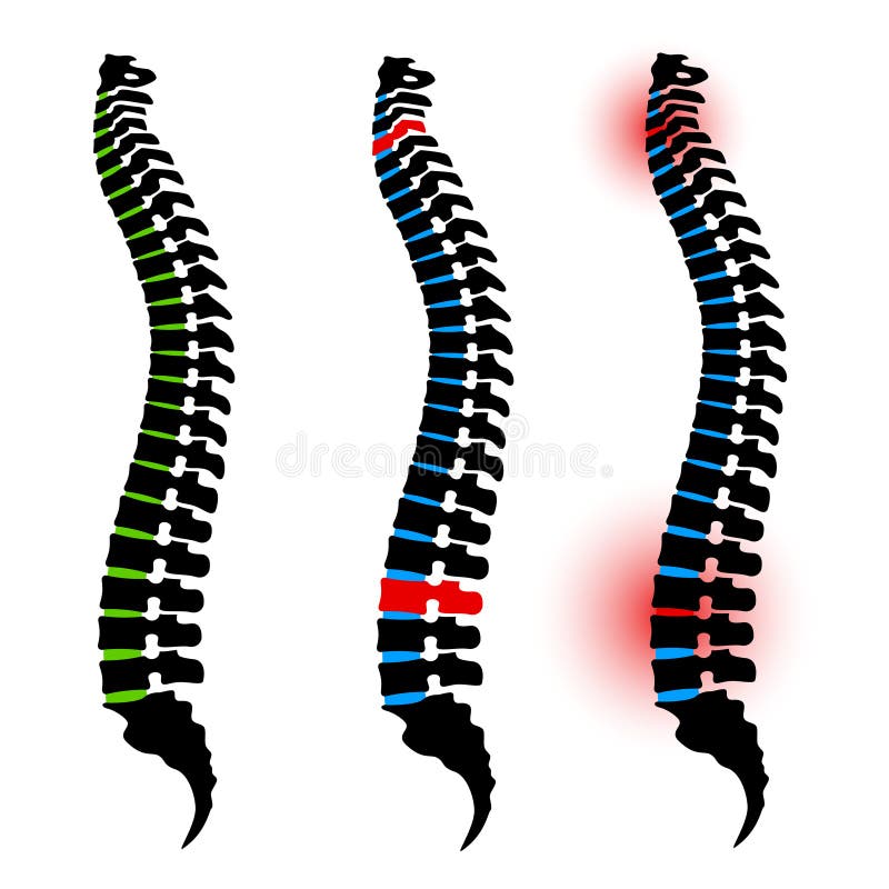 Spine Vertebrae - Color Parts Stock Illustration - Illustration of care ...
