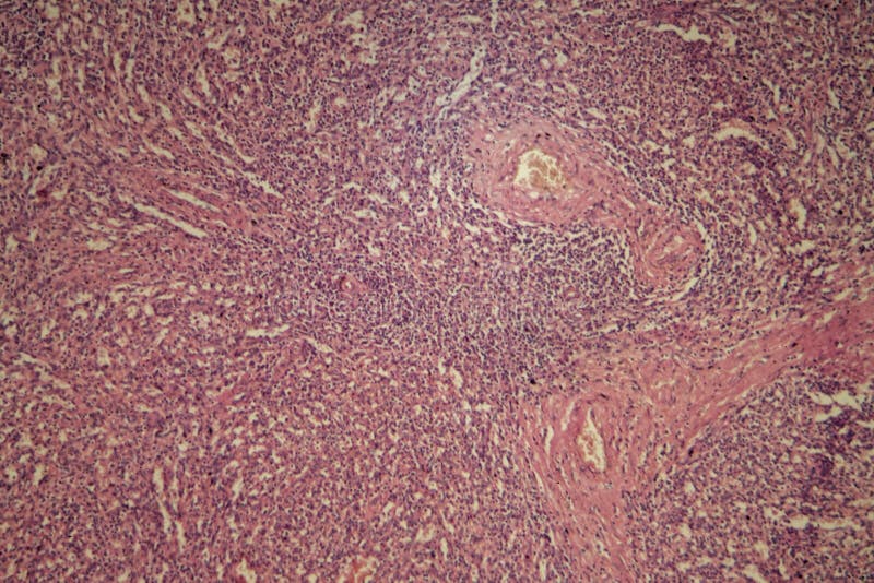 Human Spleen with Chronic Myelogenous Leukemia Stock Image - Image of ...