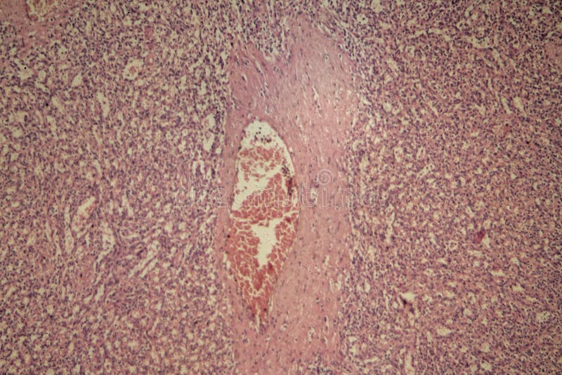 Human Spleen with Chronic Myelogenous Leukemia Stock Image - Image of ...