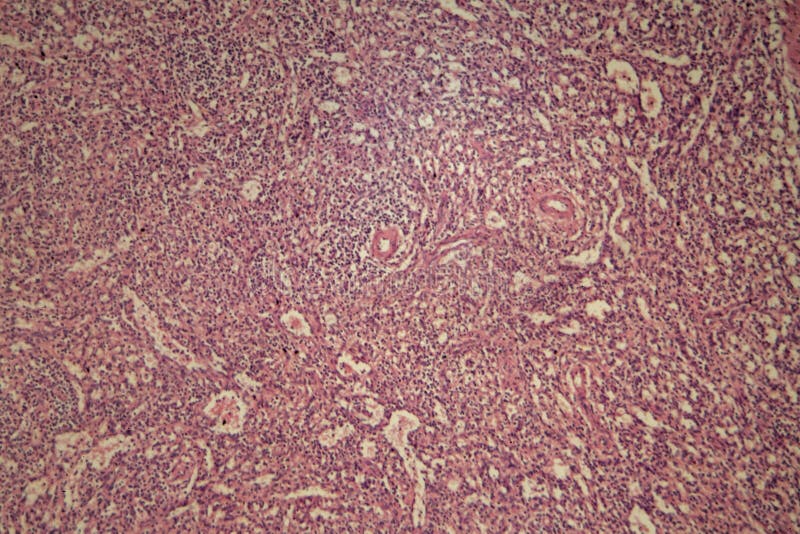 Human Spleen with Chronic Myelogenous Leukemia Stock Image - Image of ...