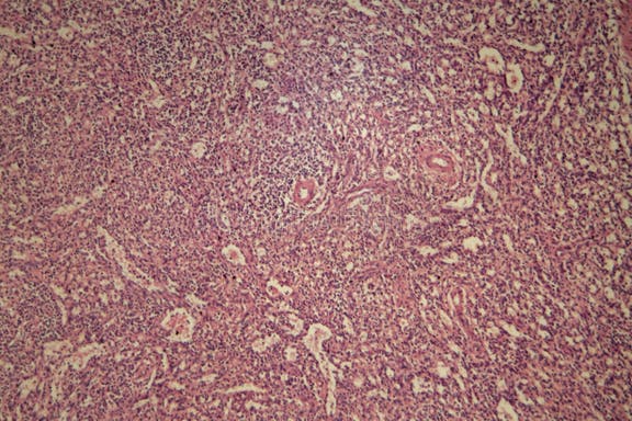 Human Spleen with Chronic Myelogenous Leukemia Stock Image - Image of ...